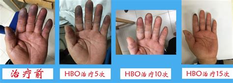 首例雷诺病的高压氧治疗疗效 新闻中心