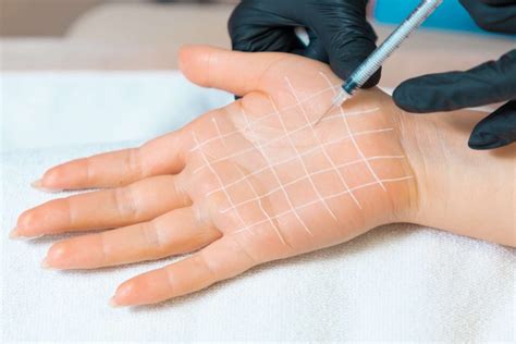 Botox And Palm Sweat How To Get Rid Of Your Hands Sweating Botulinum