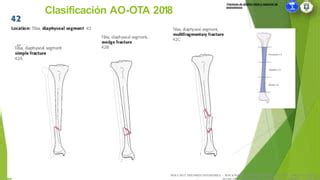 Fx Y Material De Osteosintesis De Tibia Listo Pptx