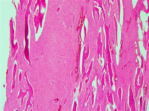 Pathology Outlines Parosteal Osteosarcoma