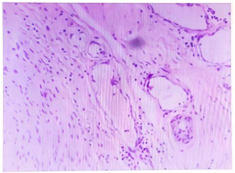 A Case Report Of Gastric Type Endocervical Adenocarcinoma Accompanied