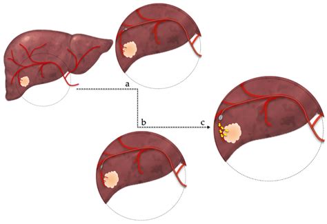 Transarterial Chemoembolization For Hepatocellular Carcinoma