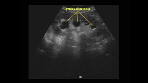 Hydronephrosis With Upj Calculus 수신증요관신우이행부 결석 Youtube