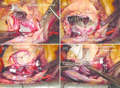 A The Stump Of Aorto Mitral Continuity Occupies 12 Of The