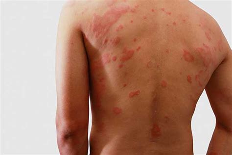 Skin Rash Symptoms Causes Emergency Room Treatment