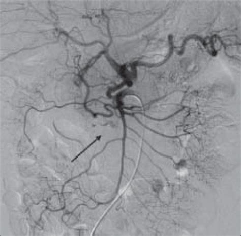 Superior Mesenteric Angiogram Shows Visualization Of The Hepatic And Download Scientific