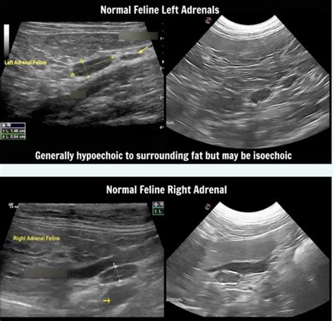 Diagram Of Ultrasound Of Adrenal Gland Quizlet