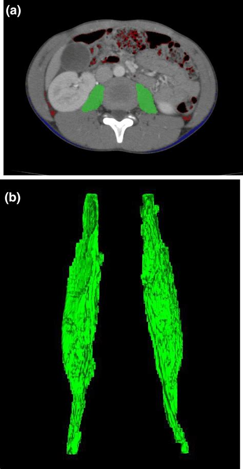 Psoas Muscle Extracted From Ct Images By The Image Analysis Software To