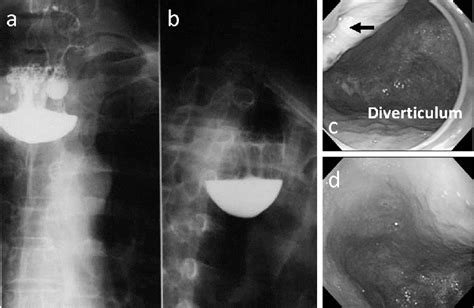 Figure 1 From Occult Early Squamous Cell Carcinoma In Zenker S