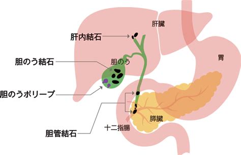 胆石症 病気と治療の検索サイト「メディカルブレイン」