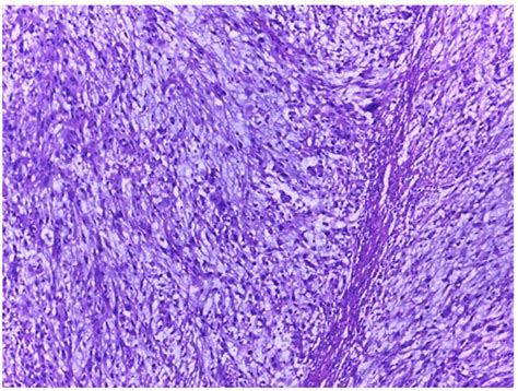 The Tumor Mass Had Myxoid Stroma Highly Pleomorphic Cells And