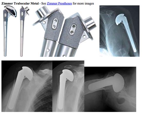 Shoulder And Elbow Surgery Identifying The Implanted Shoulder