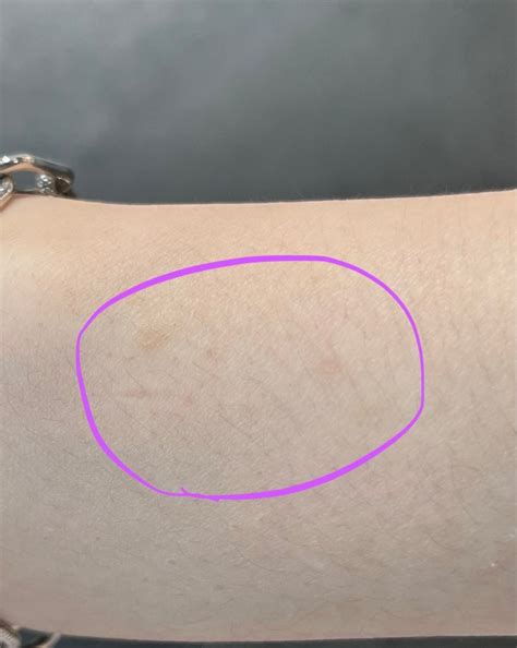 피부 반점 지식in