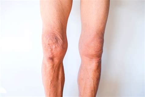 手术后肌肉萎缩怎么办 39医院诊室