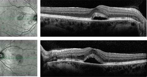 Spectral Domain Oct Showed Intraretinal Fluid And Pockets Of Subretinal Download Scientific