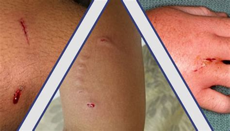 Dog Bite Symptoms Risks And First Aid Firstaidpro