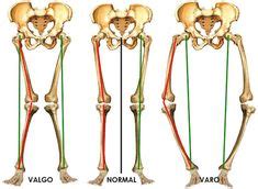 Coxa Valga Vs Coxa Vara Physical Therapy Diagnosis Therapy