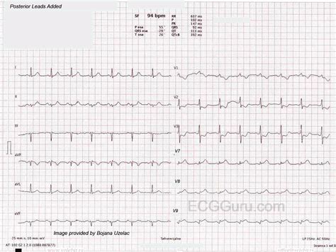 Stemi Ecg Guru Instructor Resources
