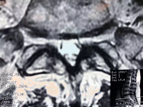 Spine Surgery Lecture Ulbd Pptx