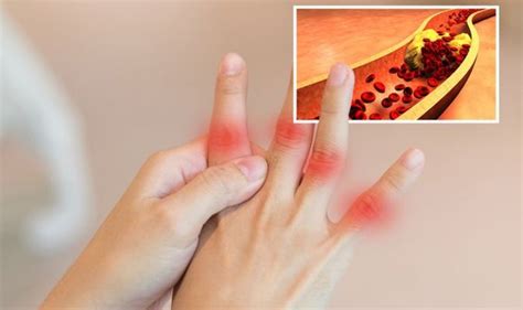 Cholesterol Bumps
