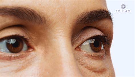 Puffy Eyes From Cpap Causes Solutions And Prevention Tips
