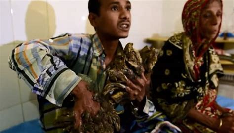 Is Tree Man Syndrome Contagious Captions Profile