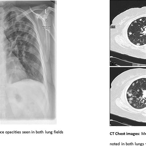 Longitudinal Us Image Of The Gallbladder Shows Comet Tail Artifact