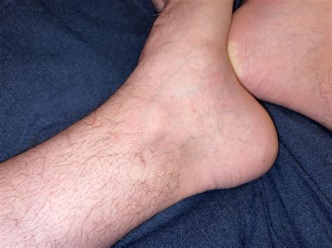 Itchy Ankles At Night Rscabies
