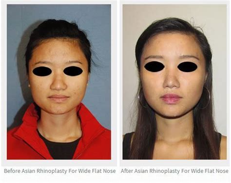 Nose Job For Flat Wide Nose Good Inside Forum Slideshow