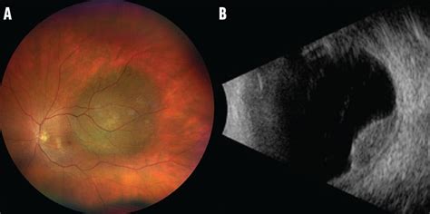 Tissue Glue Assisted Plaque Radiotherapy For Uveal Melanoma Retina Today