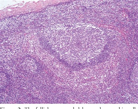 Figure 1 From Langerhans Cell Sarcoma Of The Axillary Lymph Node A