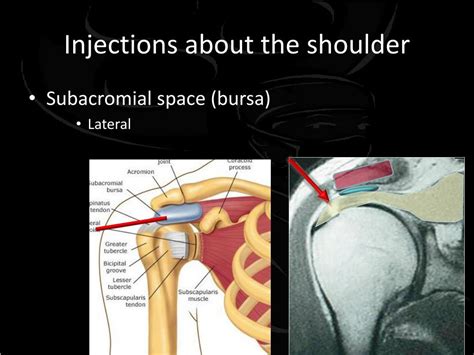 Shoulder Bursitis Injection