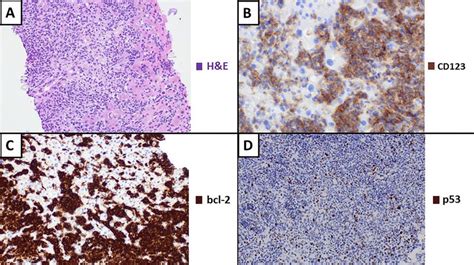 Histological Sections Of The Liver Biopsy Showed A Nodular Infiltrate