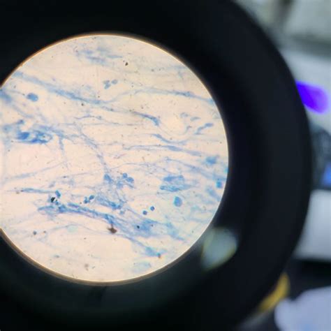 Sunil Kumar On Linkedin Sputum Afb Positive And Negative