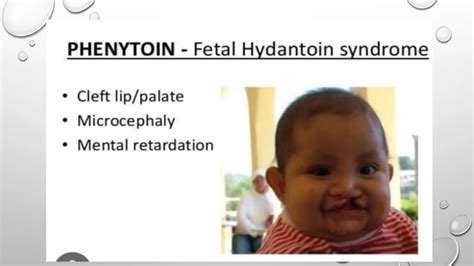 Genetic Disorders And Its Clinical Features Ppt