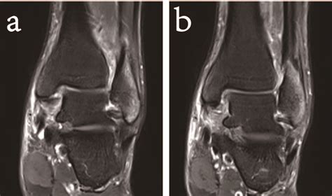 Ortho Journal On Twitter Anatomic Ligament To Bone Repair Of The