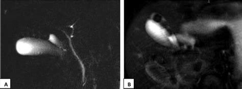 A Two Separate Gallbladders B One Gallbladder With Multiple