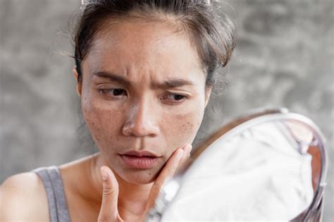 Tratamento Caseiro Para Melasma Podem Agravar As Manchas Tagfit