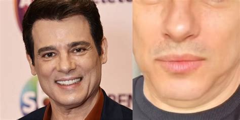 Celso Portiolli Expõe Procedimento No Rosto E Surge Irreconhecível