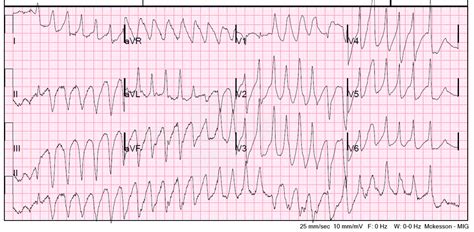 Dr Smiths Ecg Blog Polymorphic Ventricular Tachycardia