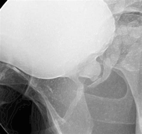 Seminal Vesicle Cyst
