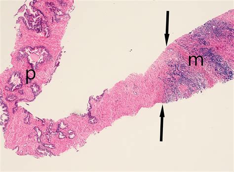 Immunoglobulin G4related Disease Of The Genitourinary System Spectrum