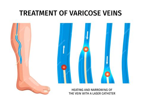 Premium Vector Treatment Of Varicose Veins Infographics Poster