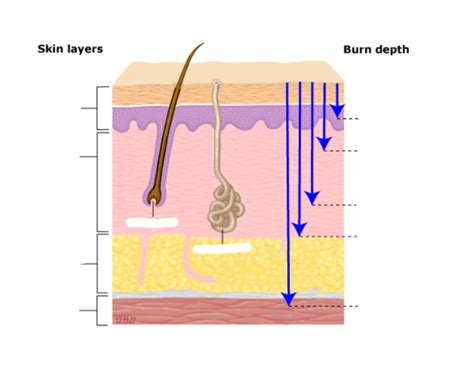 Skin Layers And Burn Depth Quiz