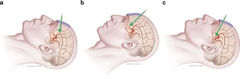 Schematic Drawings Of Intraoperative Concepts Of Anterior Download Scientific Diagram