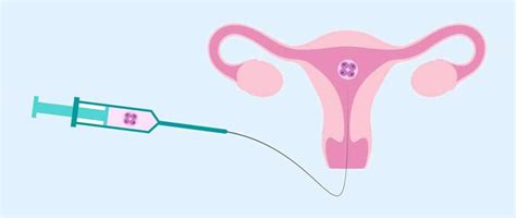 Understanding IUI