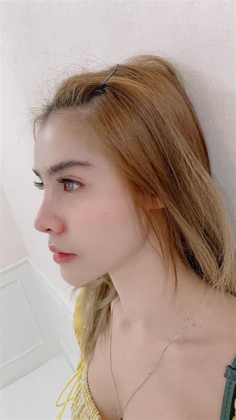 จมูกเเท่งใหม่ กับ ตัดปีก คุณหมอยู จ้า โปรจัดหนักคุ้มๆ 🌈ตอกฐาน งานเหลาพรีเมี่ยม ขึ้นทรง