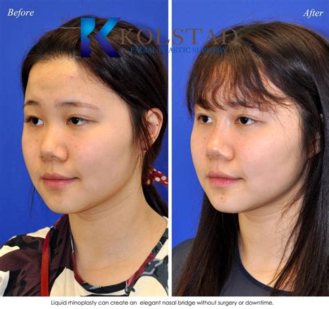 Non Surgical Asian Rhinoplasty San Diego Before And After Gallery 1 Dr Kolstad San Diego