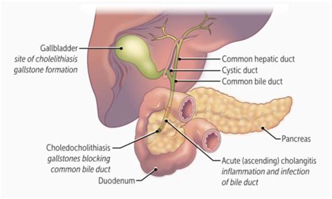 Cholangitis Flashcards Quizlet