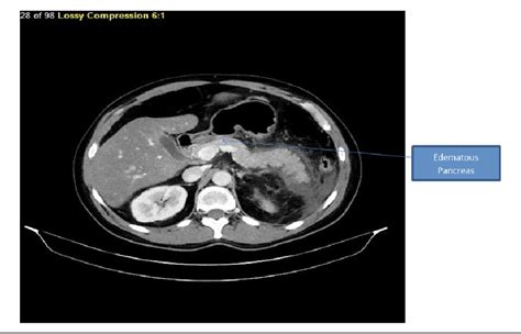 Figure 2 From A Rare Case Of Acute Pancreatitis Due To Very Severe Hypertriglyceridemia 10 000